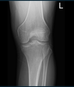 Case Study: Knee Arthroscopy ACL Construction using Quad Tendon ...