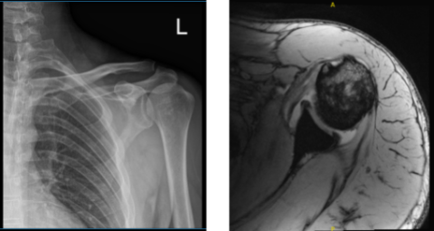Case Study: Shoulder Debridement and Mini-Open Biceps Tenodesis ...