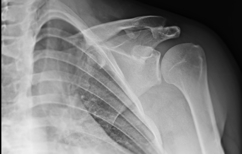 Case Study: Shoulder Arthroscopy with Slap Lesion Repair - Complete ...