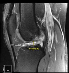 Case Study: Knee Arthroscopic Lateral Meniscus and Microfracture ...