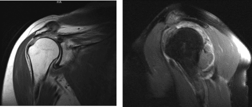 Rotator Cuff Tear Clavicle Excision | Complete Orthopedics