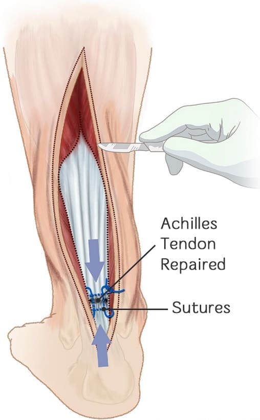Achilles Tendon Rupture Faqs Complete Orthopedics Multiple Ny