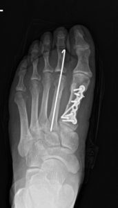 Case Study: ORIF Surgery for Right Foot Metatarsal Fractures